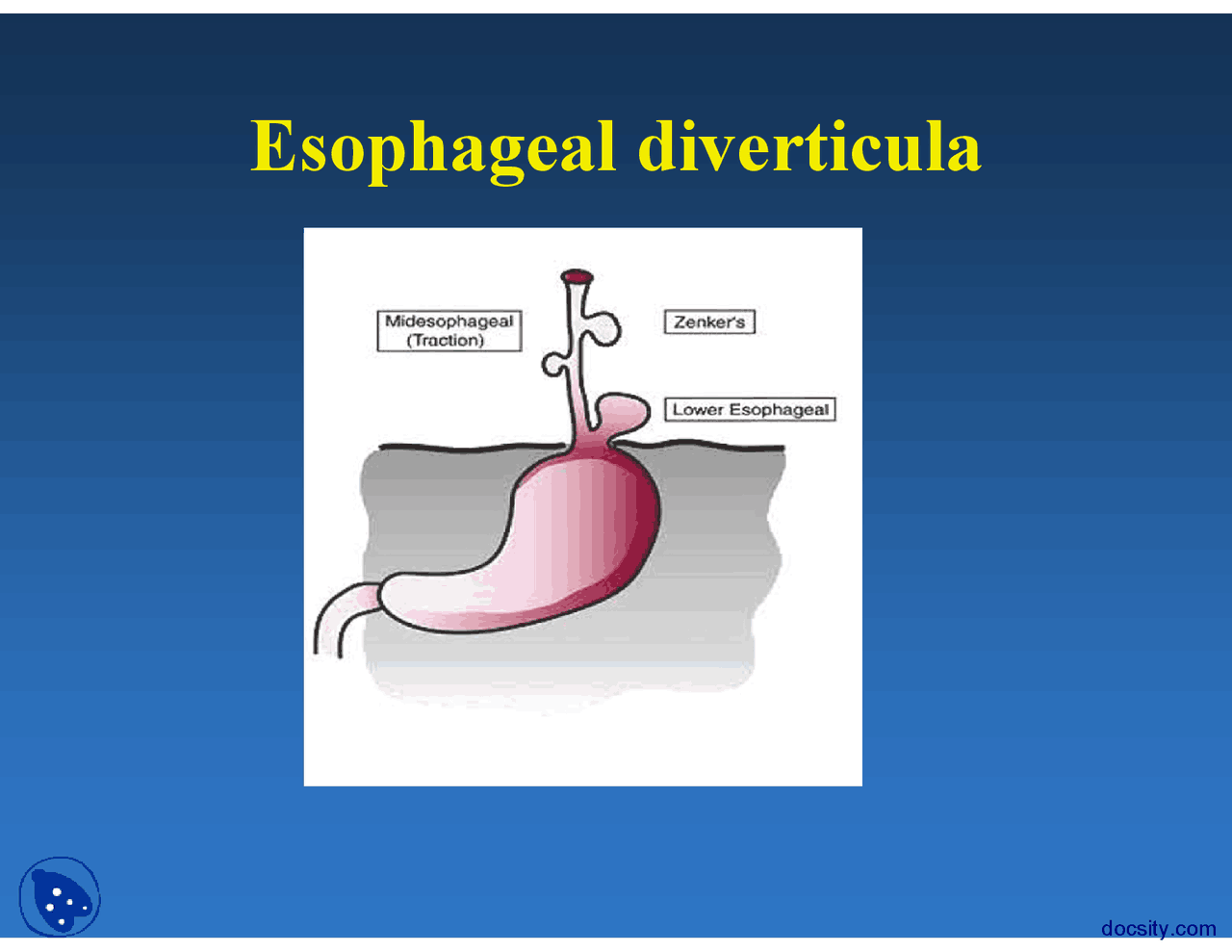 Esophageal Diverticula-Pathophysiology In Medicine-Lecture Slides - Docsity