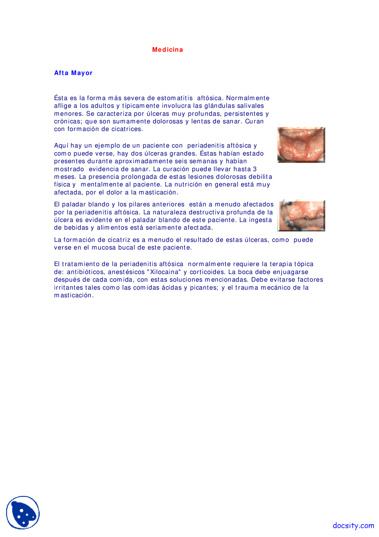 Afta mayor – Apuntes – Medicina - Docsity