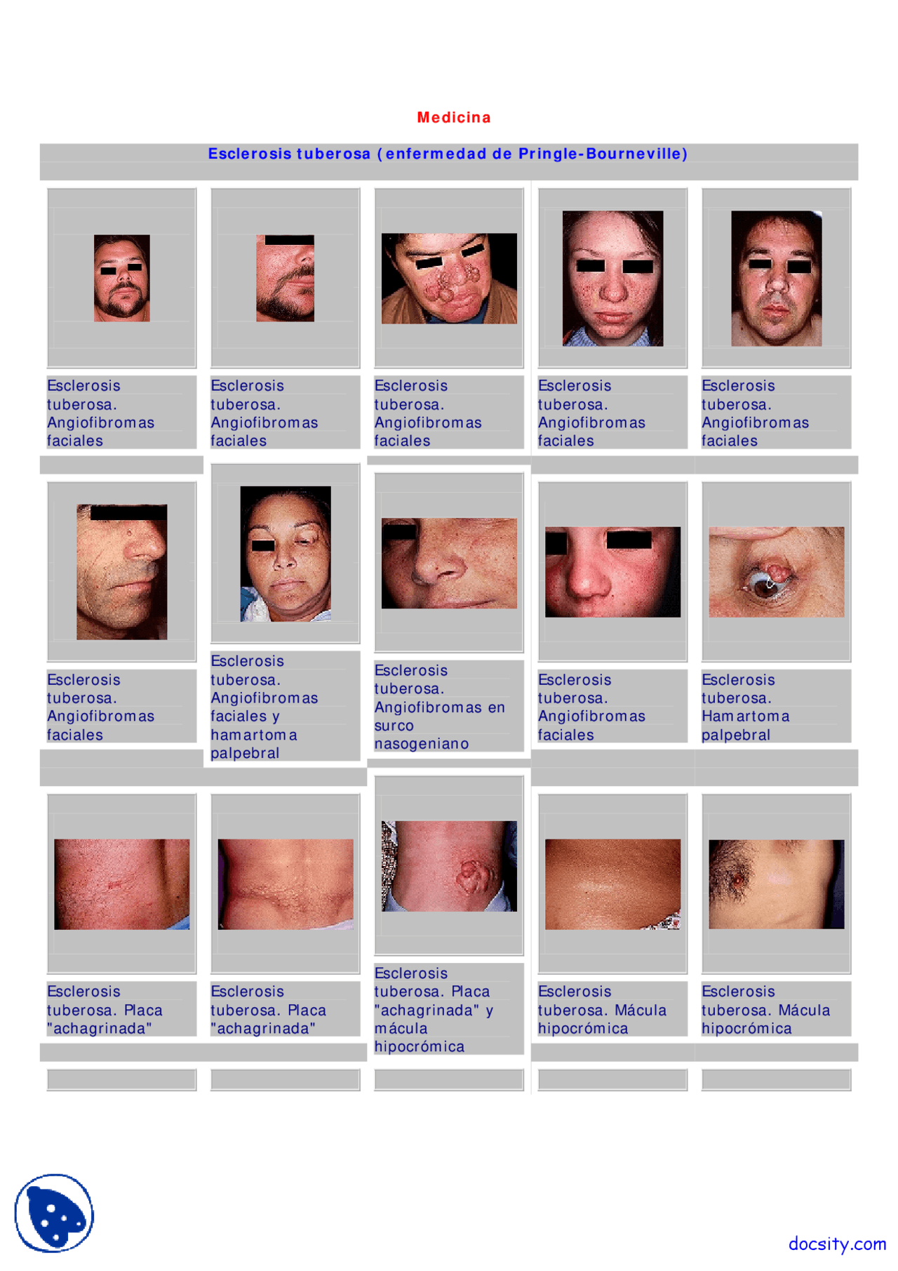 Escelerosis tuberosa - Enfermedad de Pringle Bourneville – Apuntes ...