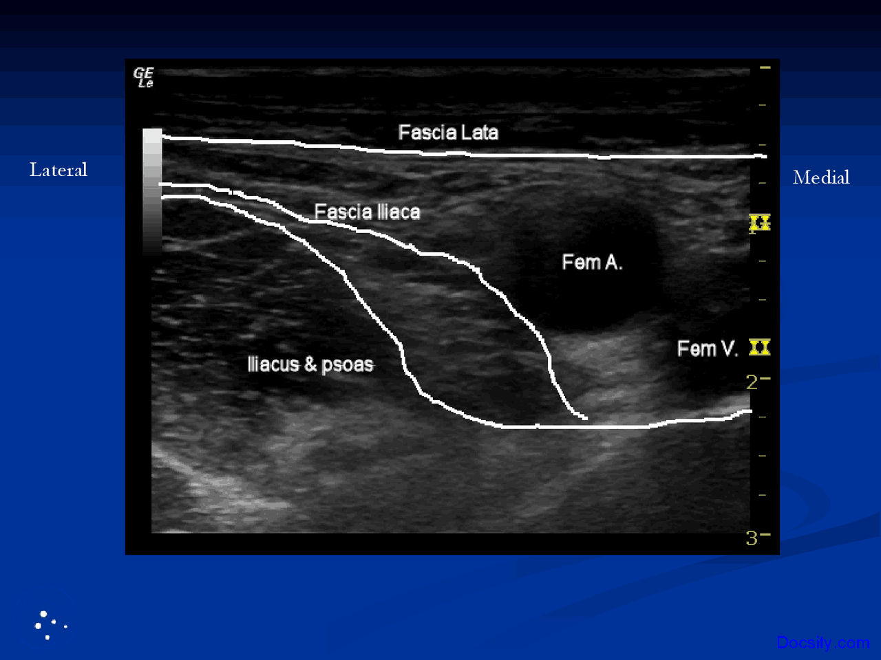 Ultrasound Guided Blocks Part 2 Anesthesia Lecture Slides Docsity