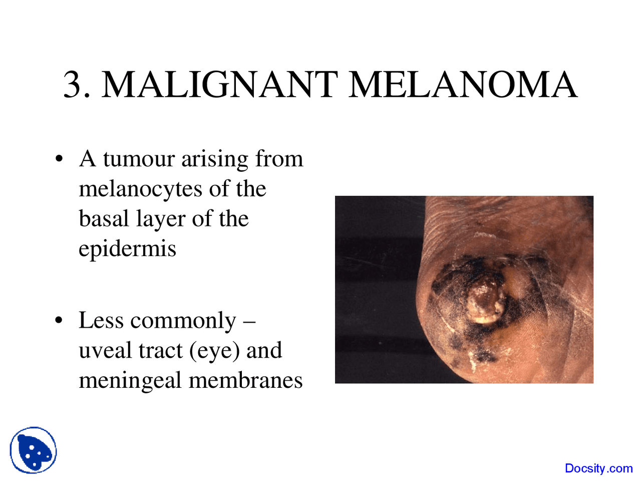 Malignant Melanoma - Dermatology - Lecture Slides | Slides Dermatology ...