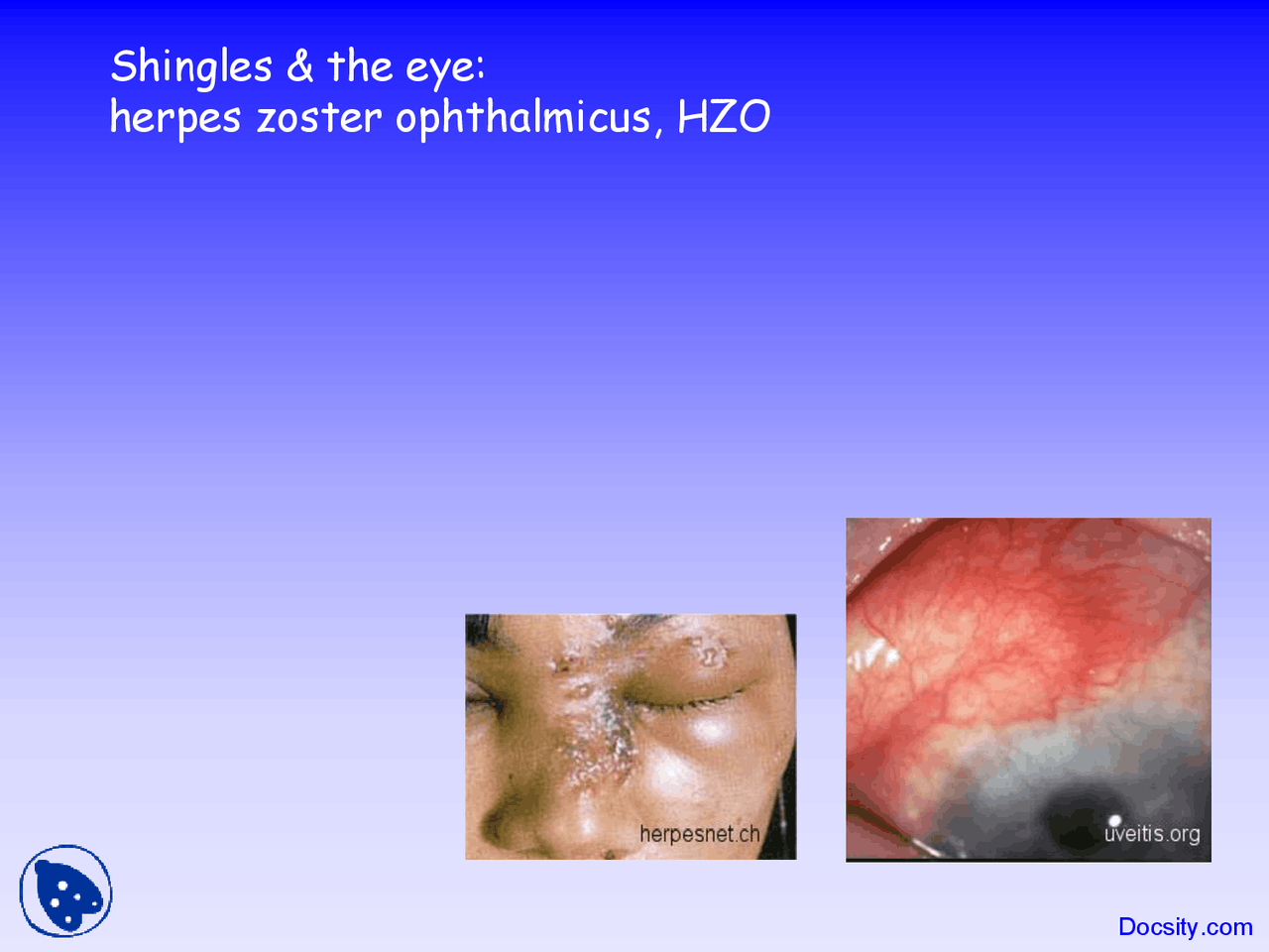 Herpes Zoster Ophthalmicus - Dermatology - Lecture Slides - Docsity