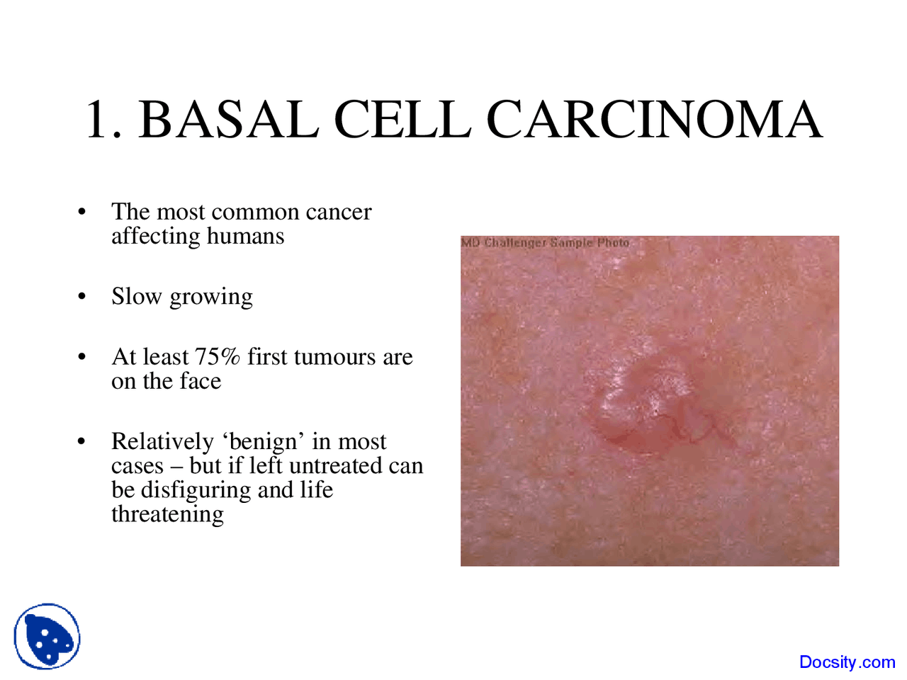 Basal Cell Carcinoma Dermatology Lecture Slides Docsity