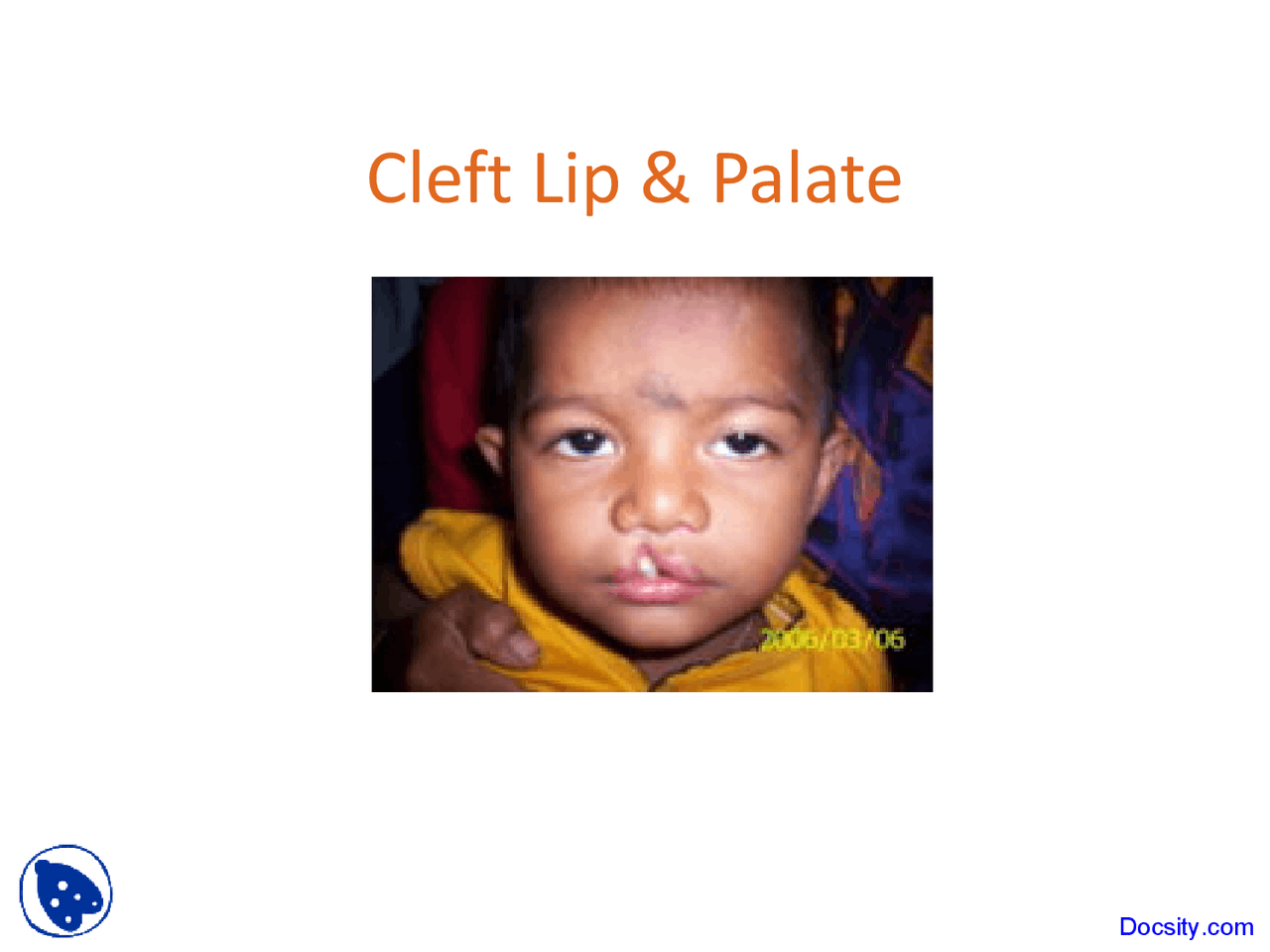 Cleft Lip And Palate Neonatology Lecture Slides Docsity