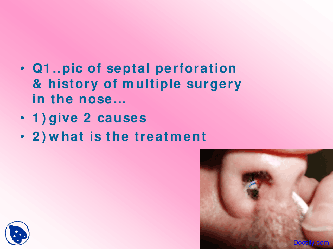 Septal Perforation - Otolaryngology - Lecture Slides - Docsity