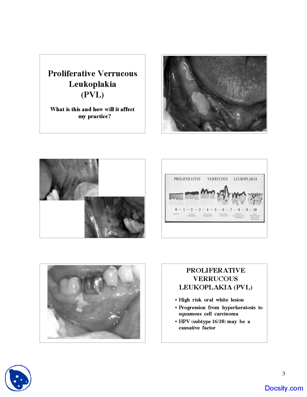 Proliferative Verrucous Leukoplakia - Oral and Maxillofacial Pathology ...