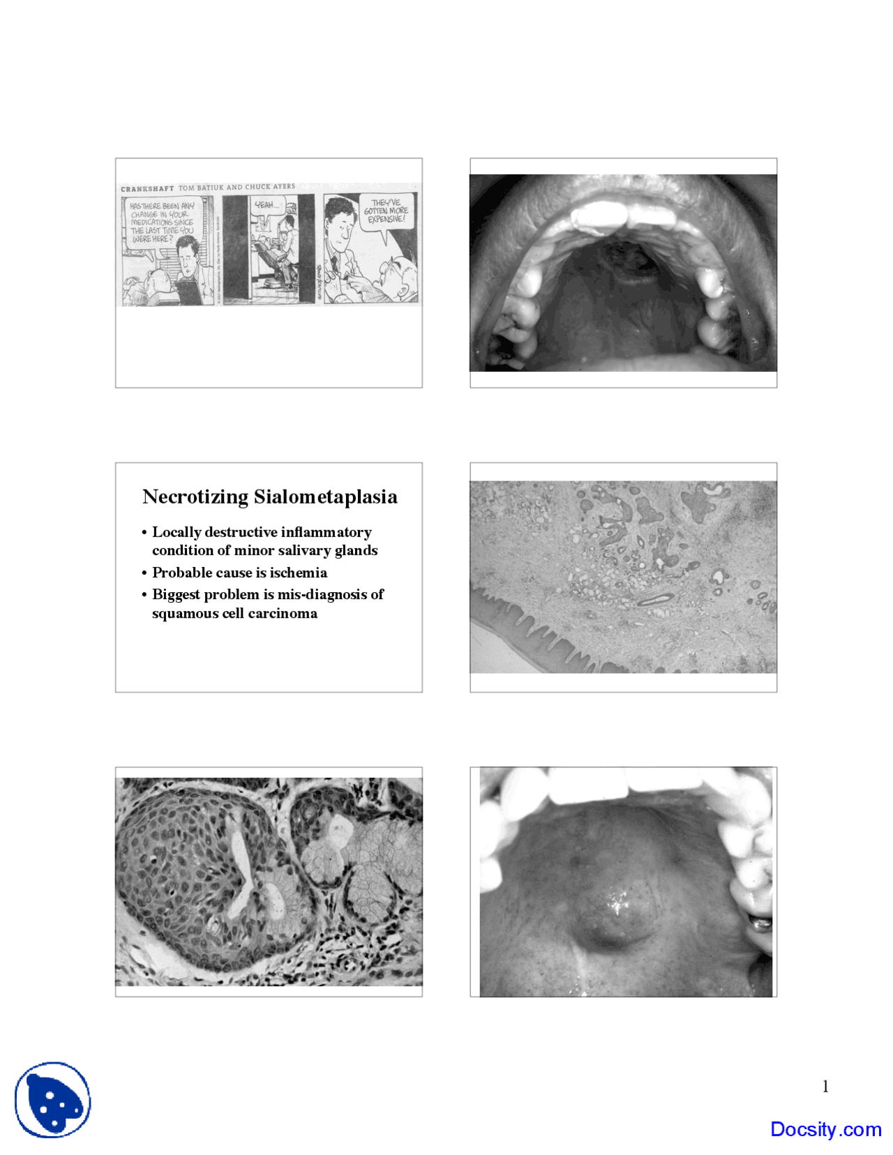 Necrotizing Sialometaplasia - Oral and Maxillofacial Pathology ...