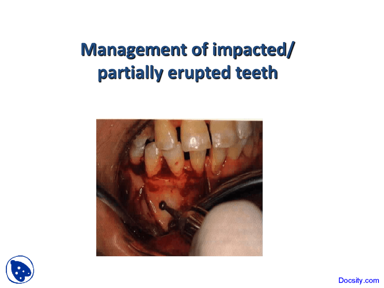 Management of Impacted Partially Erupted Teeth - Oral and Maxillofacial ...