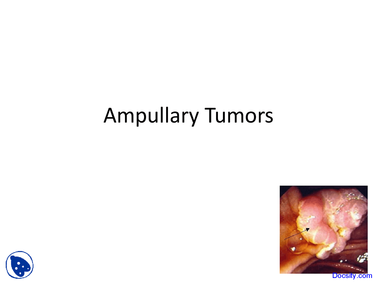 Ampullary Tumors - Surgery - Lecture Slides - Docsity