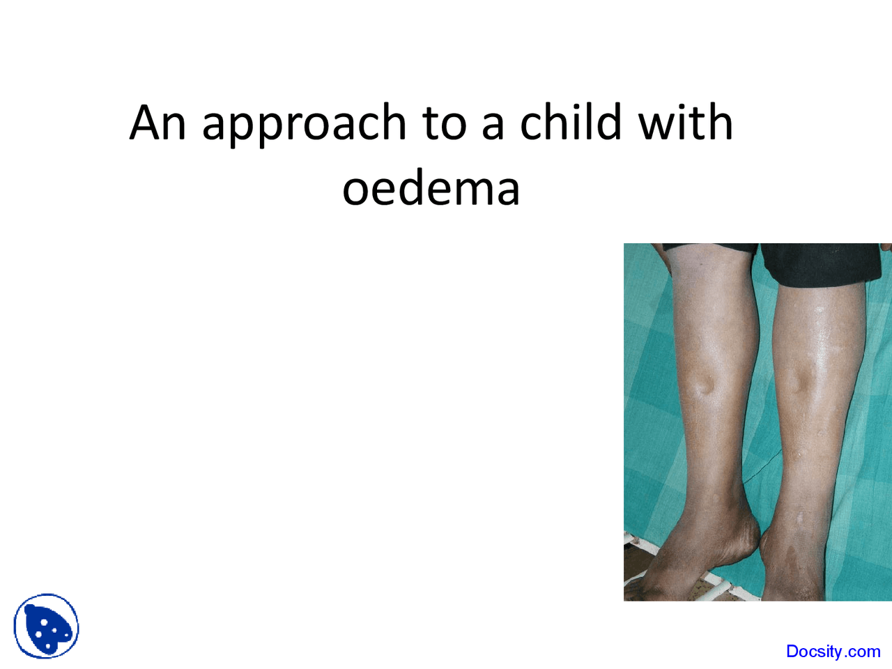 Approach to Child with Oedema - Pediatrics - Lecture Slides - Docsity