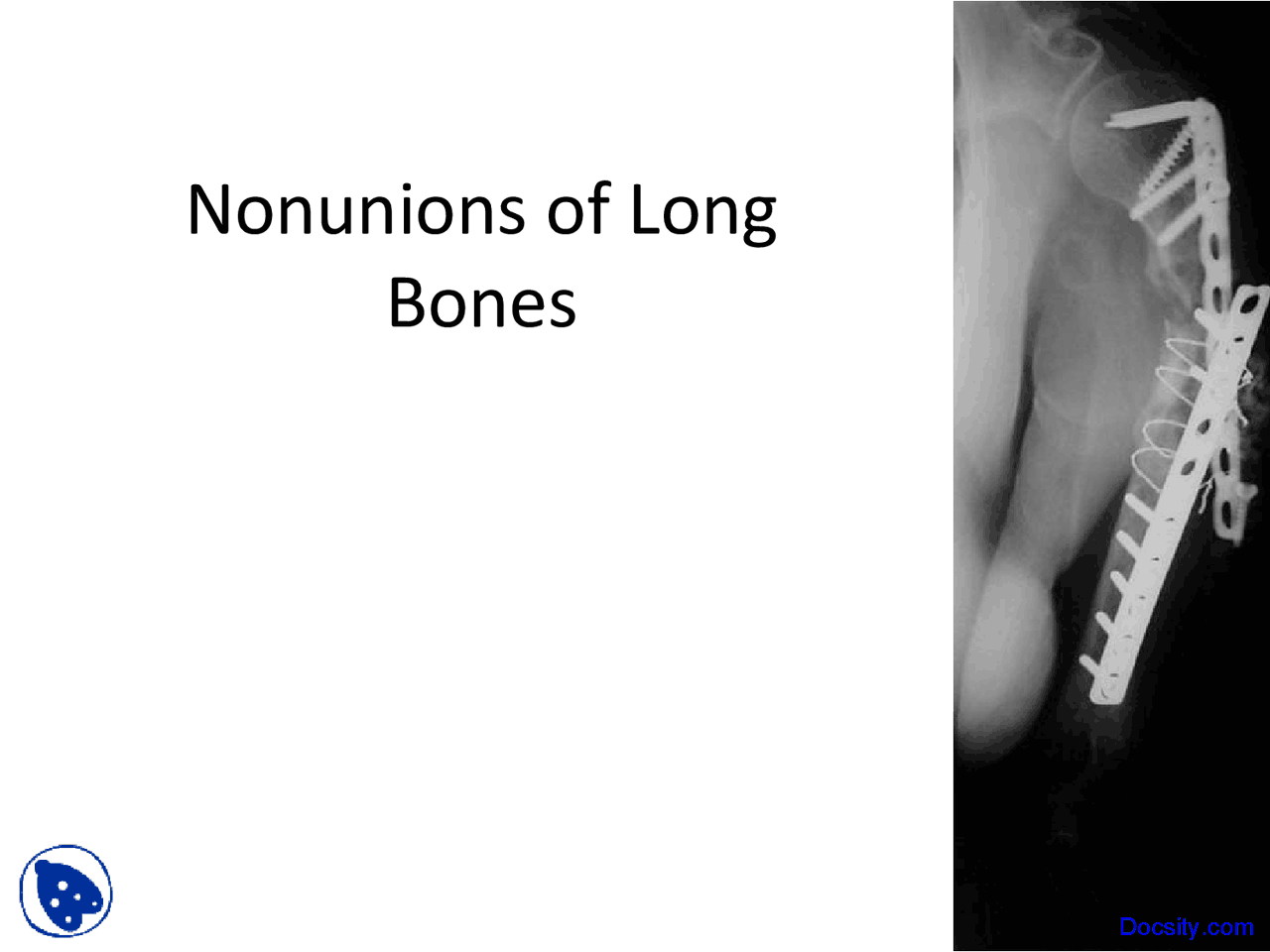 Nonunions of Long Bones - Orthopaedic Trauma - Lecture Slides - Docsity