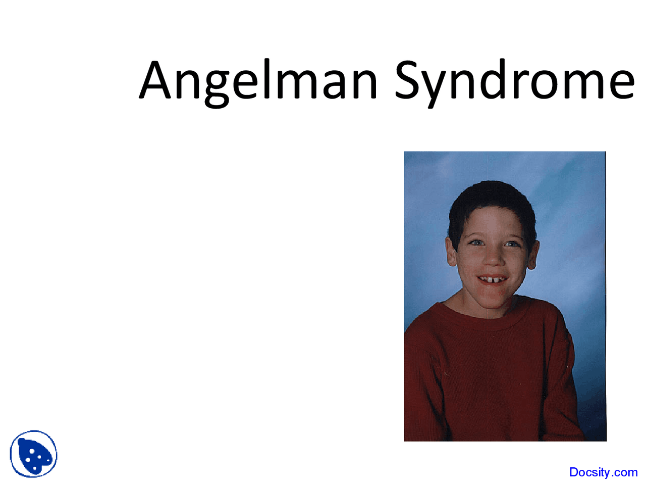 Angelman Syndrome - Pediatrics - Lecture Slides - Docsity