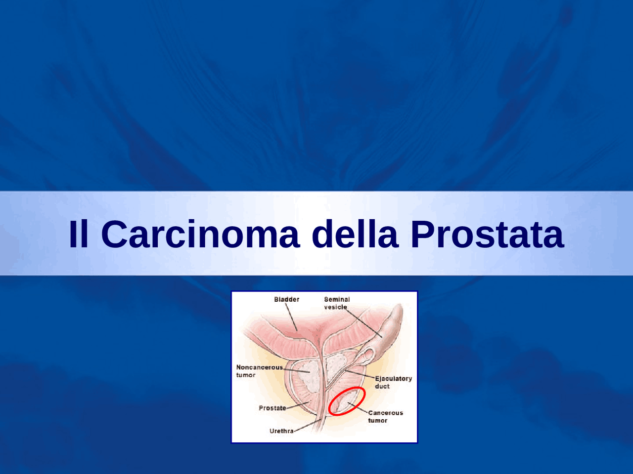 Cancro prostata - Docsity