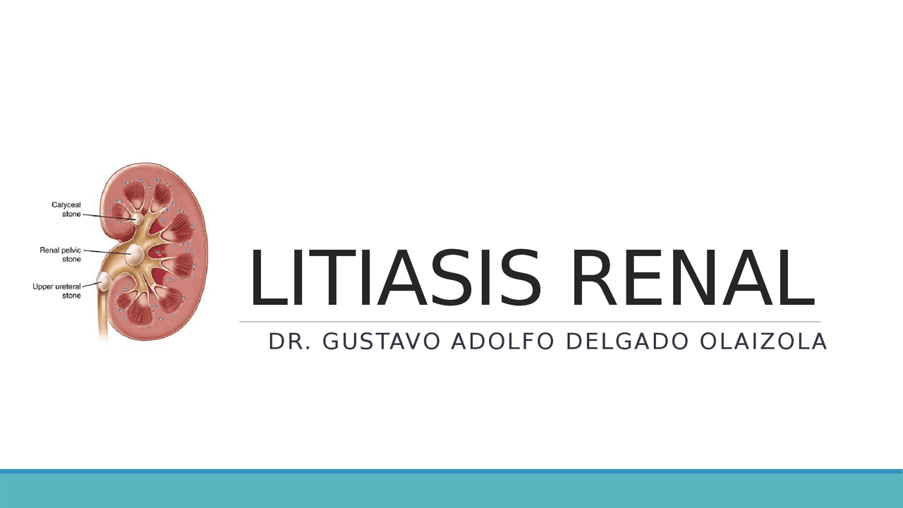 Litiasis renal: fisiopatología, clínica y tratamiento | Diapositivas de ...