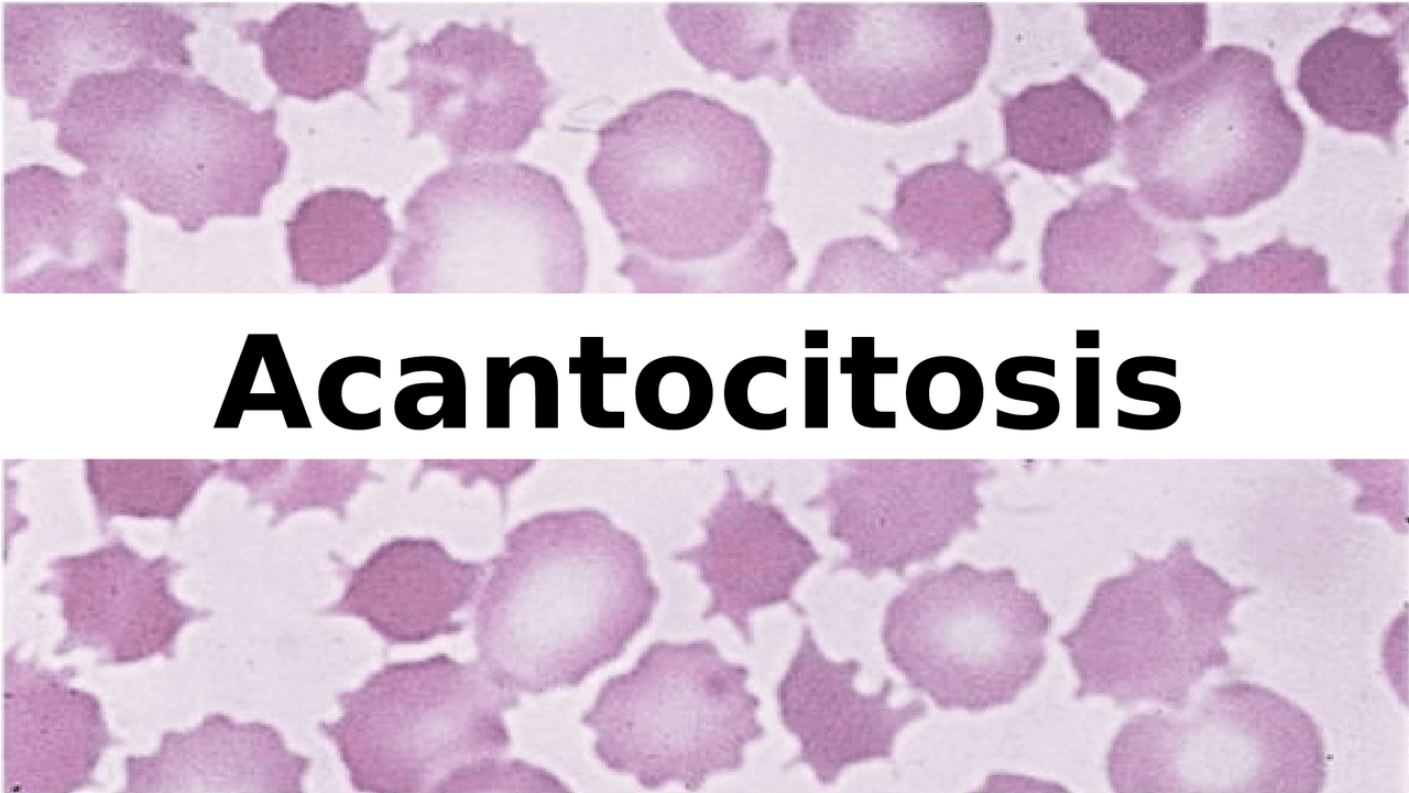 Acantocitosis , tipo de anemia hemolitica - Docsity