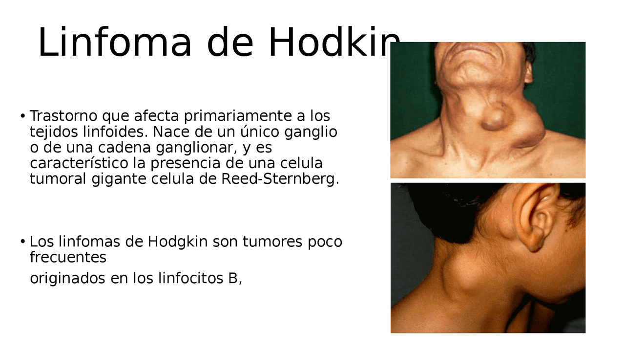 Linfoma de Hodkin resumen - Docsity