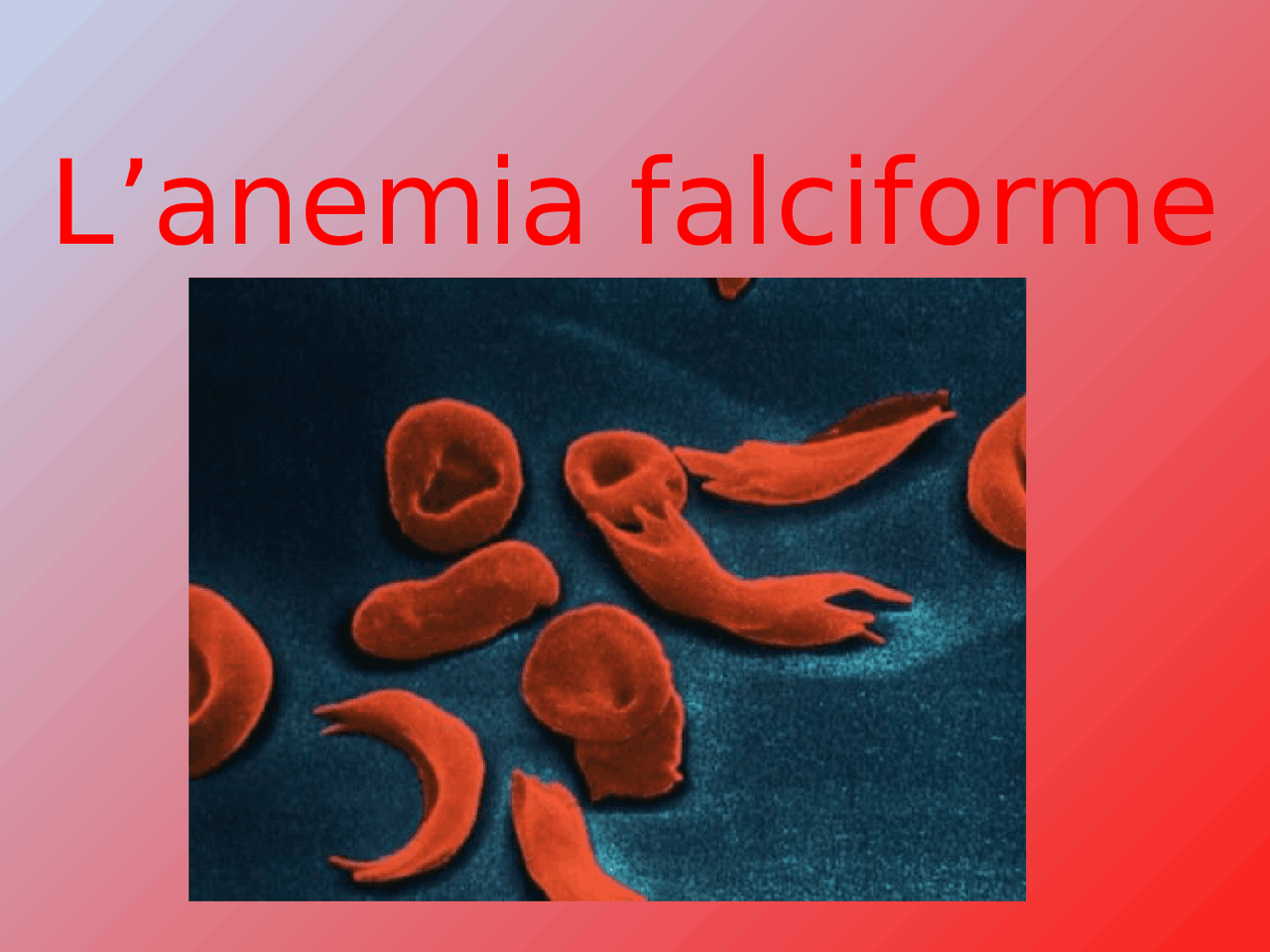Anemia Falciforme, con le varie caratteristiche - Docsity