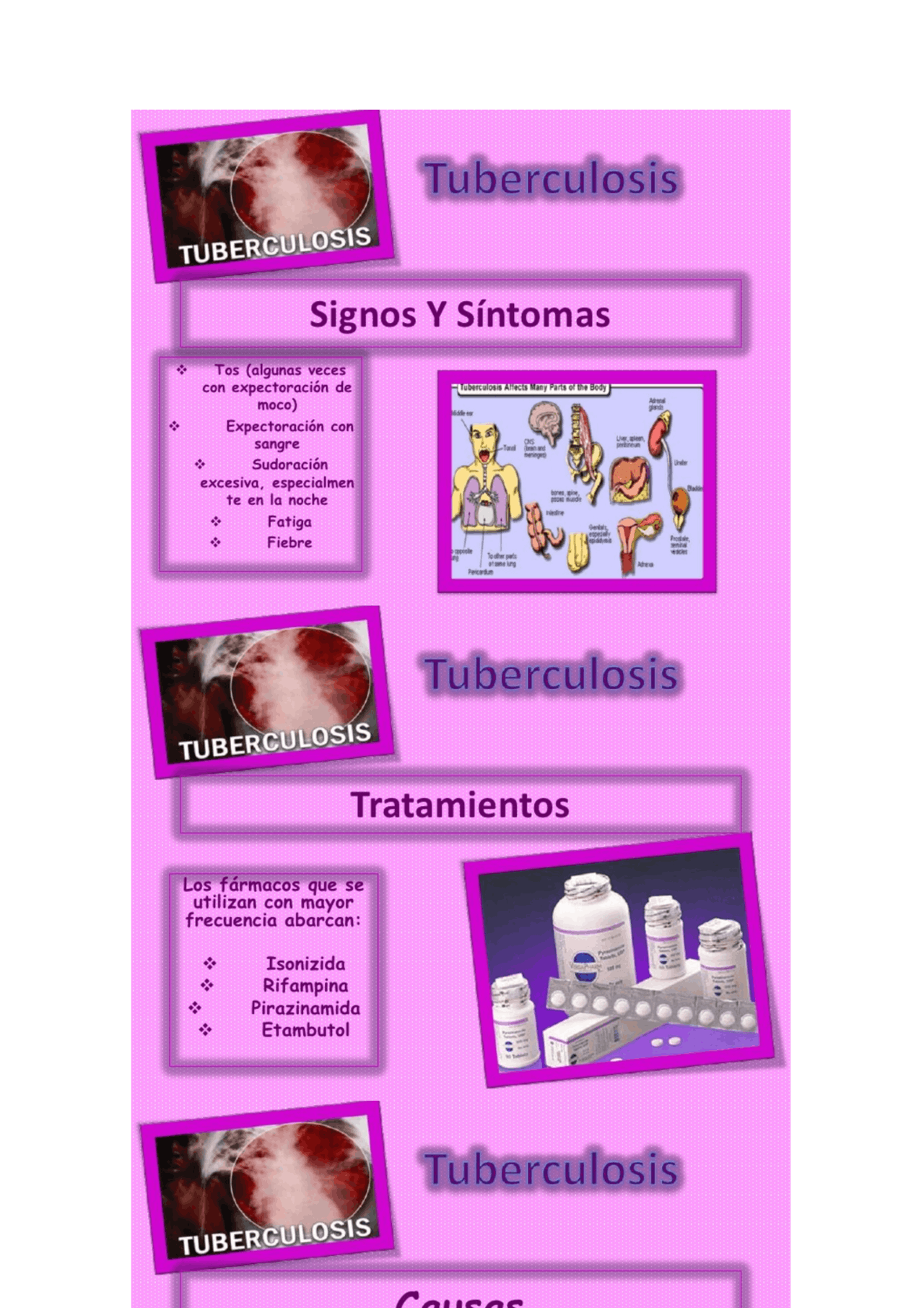Tuberculosis: signos y síntomas - Docsity