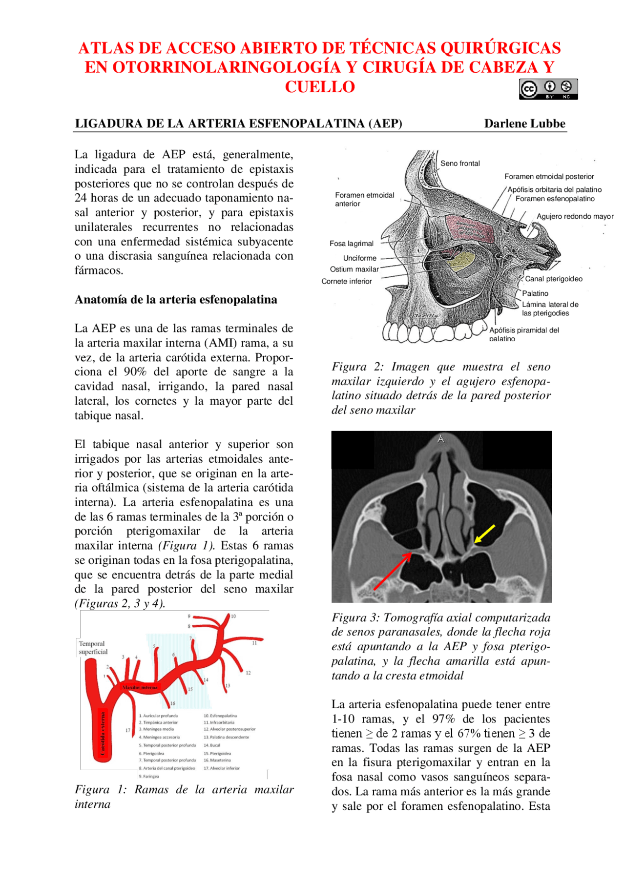 Anatomía De La Arteria Maxilar