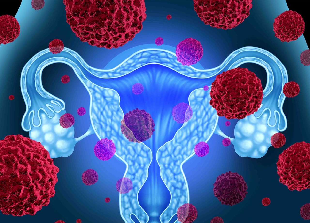 Cancer de cuello uterino | Resúmenes de Inglés | Docsity