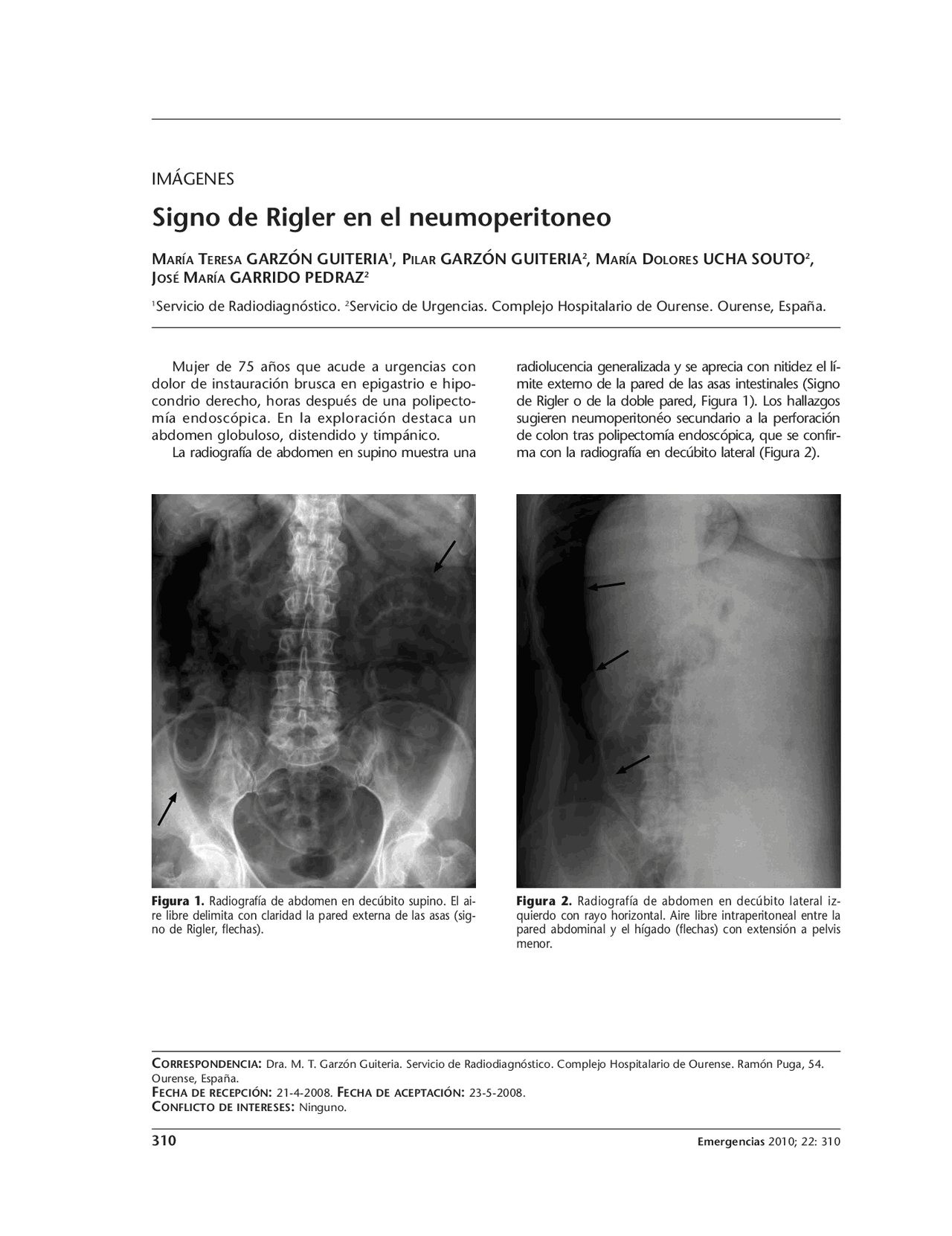 Signos Radiologicos Del Neumoperitoneo
