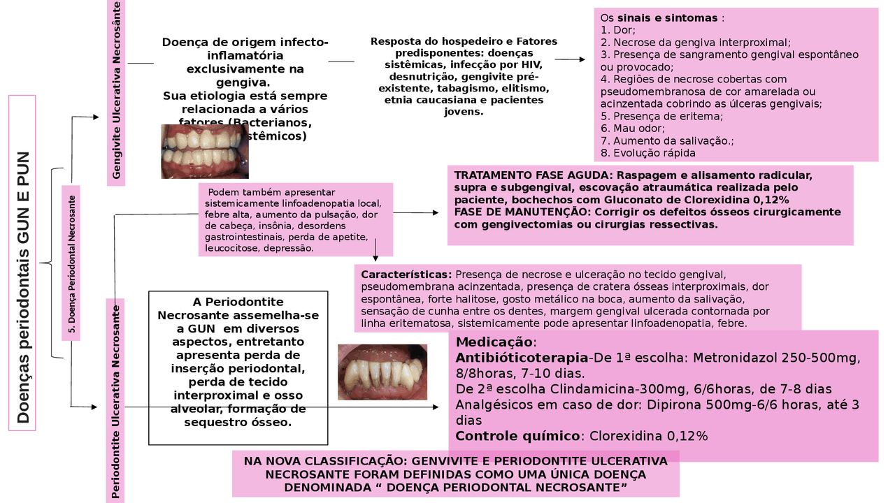 Histologia De Gengivite Ulcerativa Necrosante