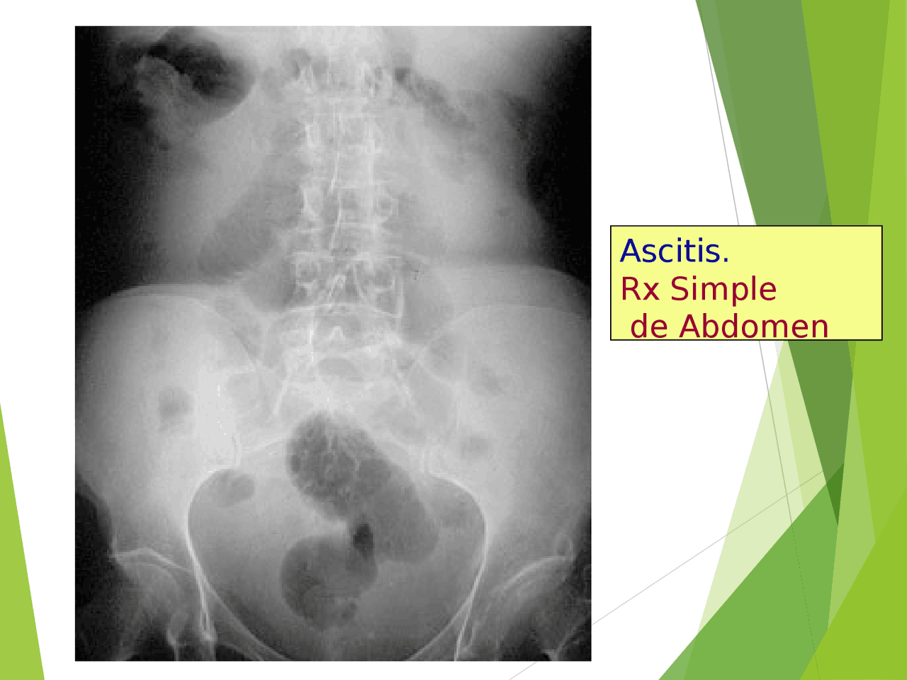 Ascitis- tratamiento - Docsity