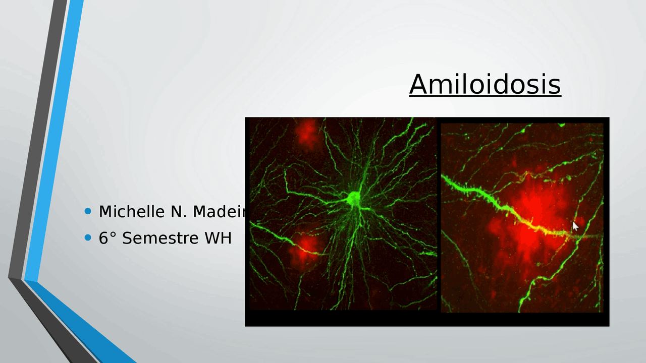 Amiloidos , tratamiento y diagnostico - Docsity
