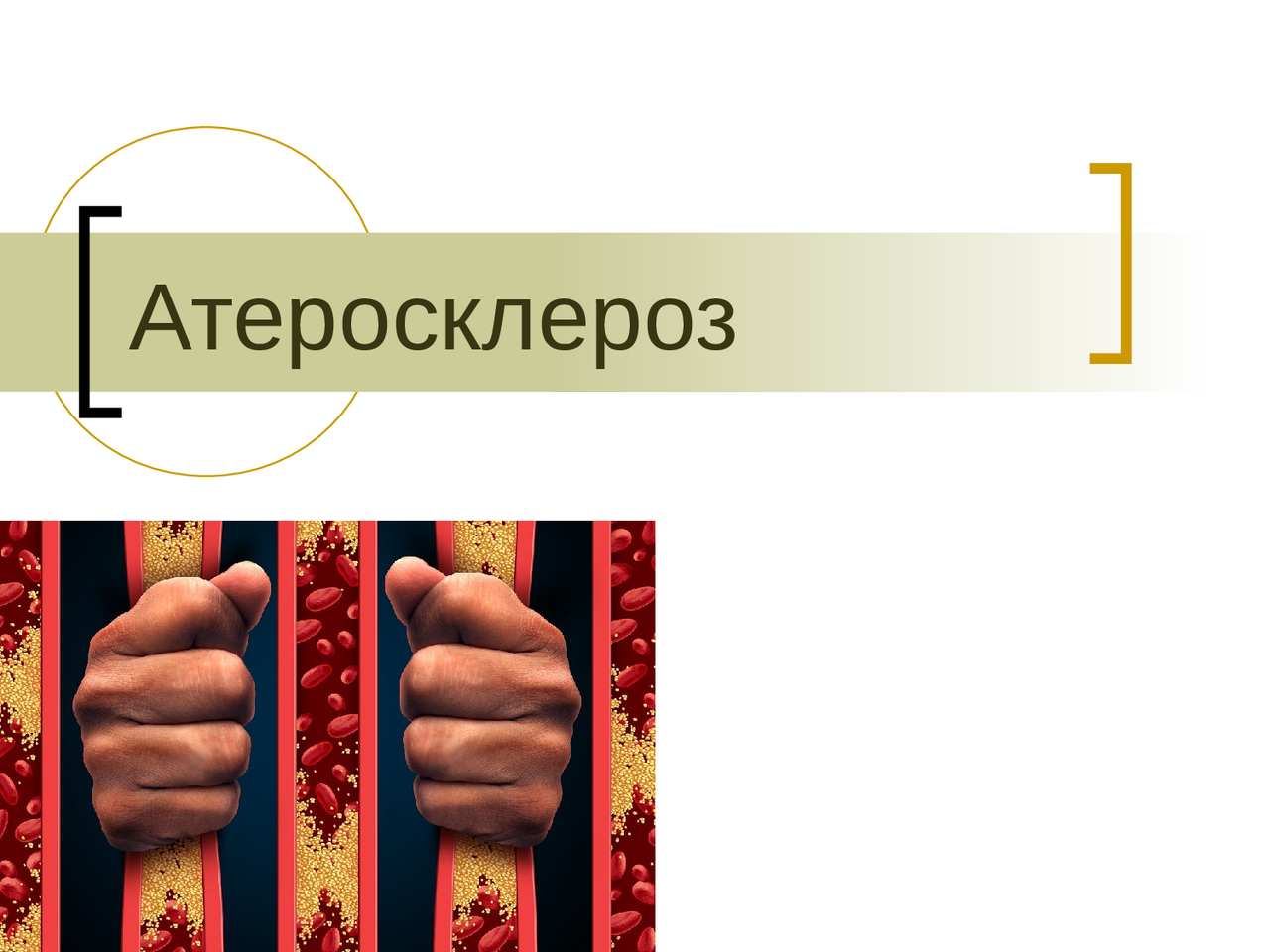 Патофизиология атеросклероза Docsity