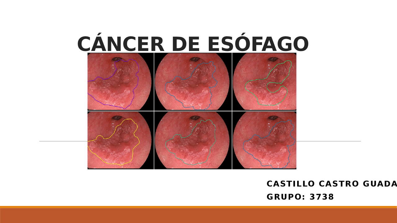 Enfermedad De Esófago Diapositivas De Gastroenterología Docsity