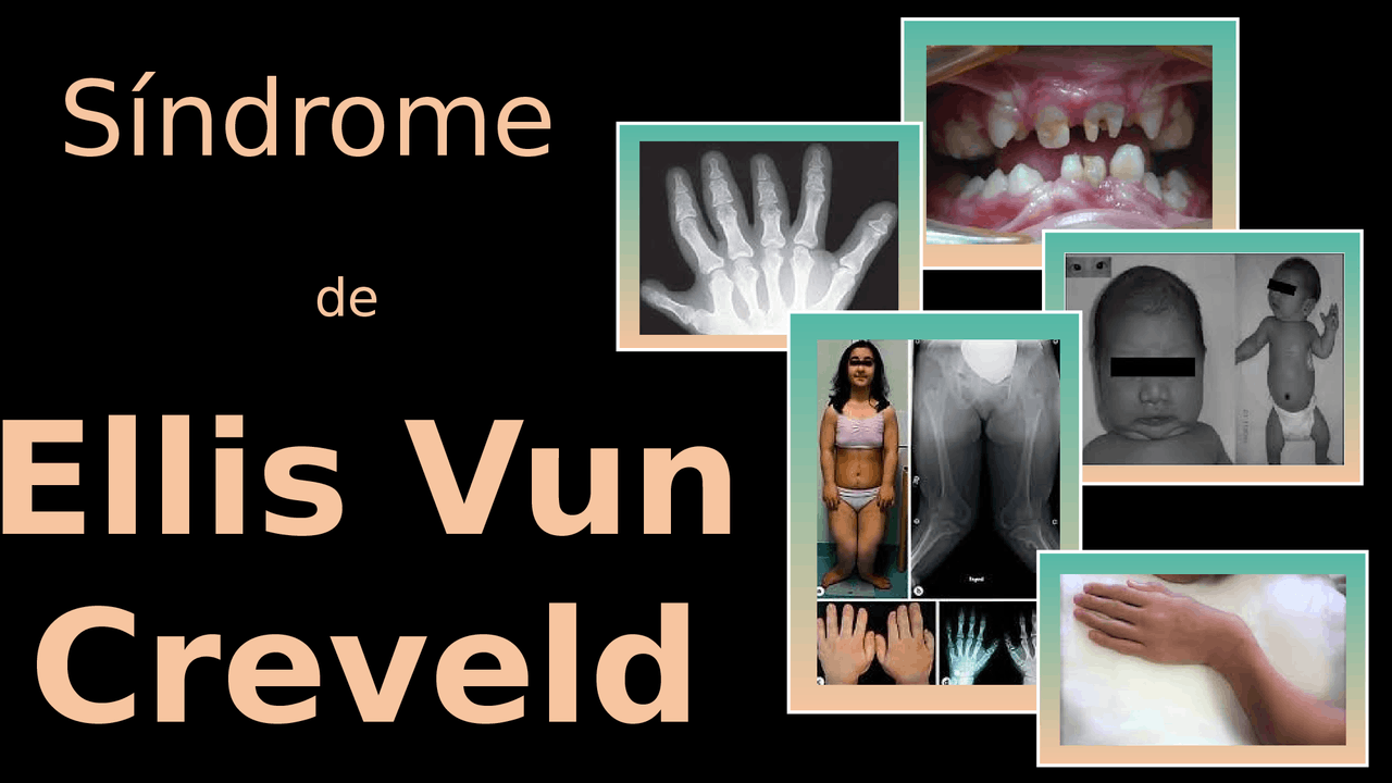 Síndrome de ellis van creveld - Docsity
