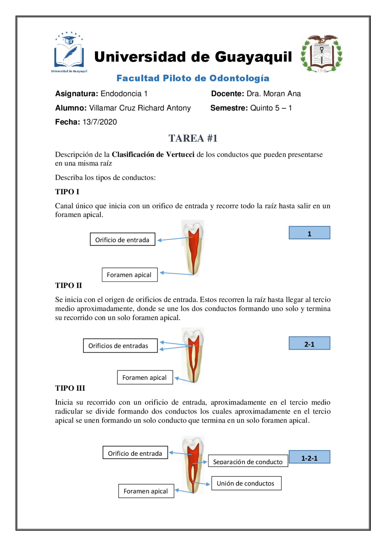CLASIFICACIÓN DE VERTUCCI | Apuntes de Endodoncia | Docsity