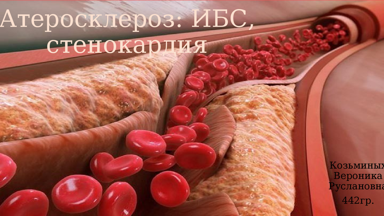 Атеросклероз ИБС Стенокардия Презентация Docsity
