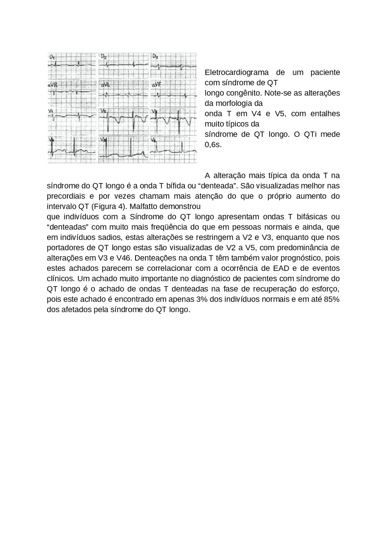 Sindrome Do Qt Longo Docsity