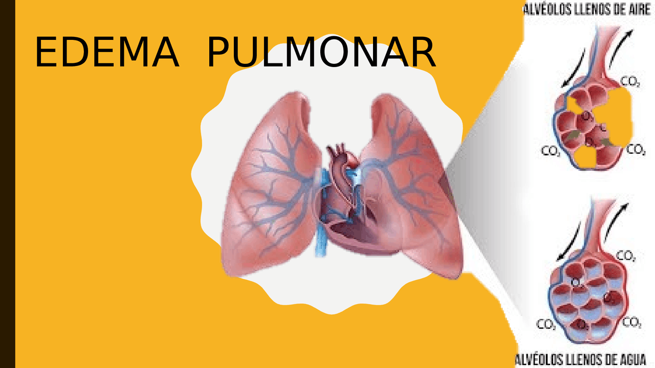 EDEMA PULMONAR hallazgos radiologicos | Diapositivas de Diagnóstico por ...
