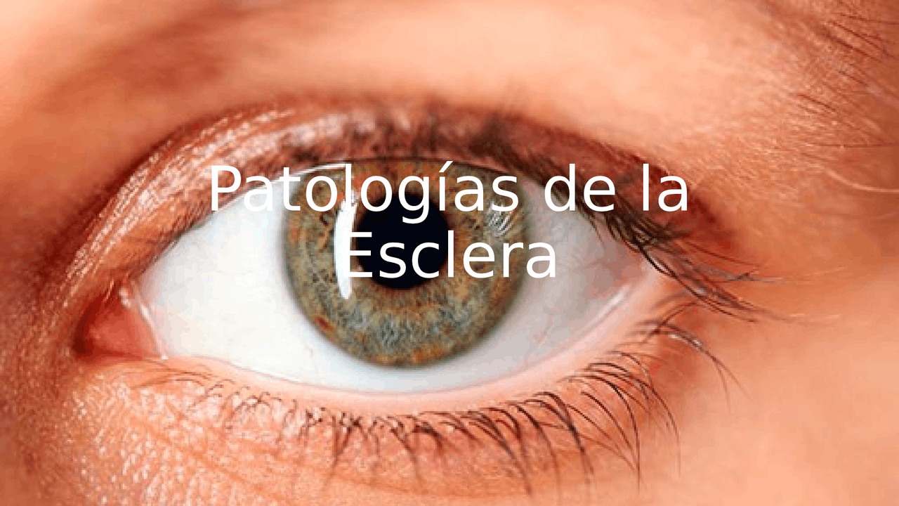 Oftalmología: Patologías de la Esclera | Diapositivas de Oftalmología ...