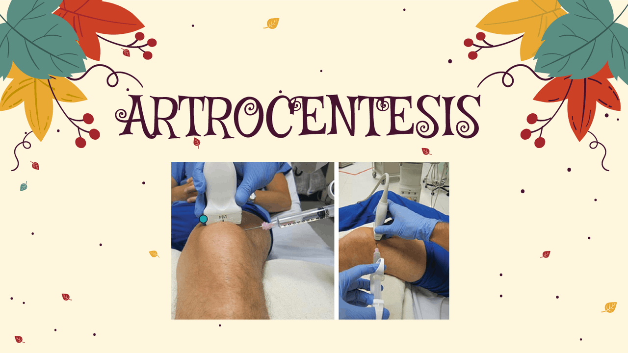 Aspiracion articular (artrocentesis) - Docsity