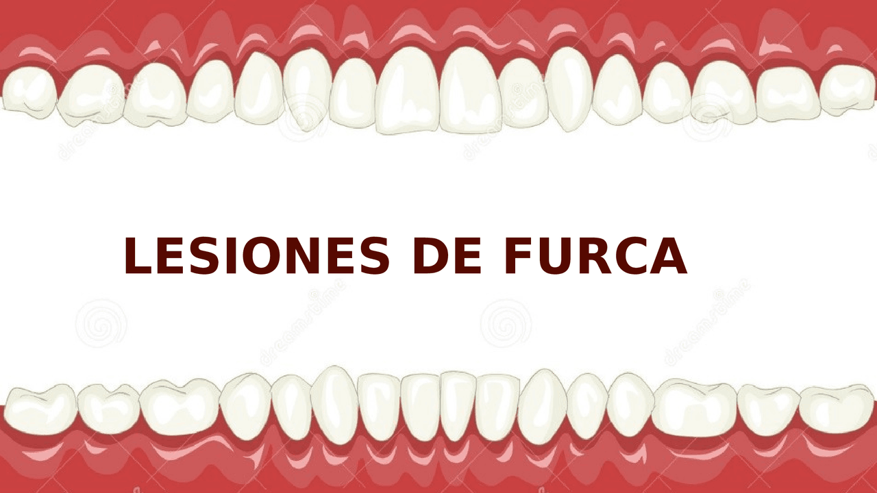 Lesiones a nivel de la furca en piezas dentales - Docsity