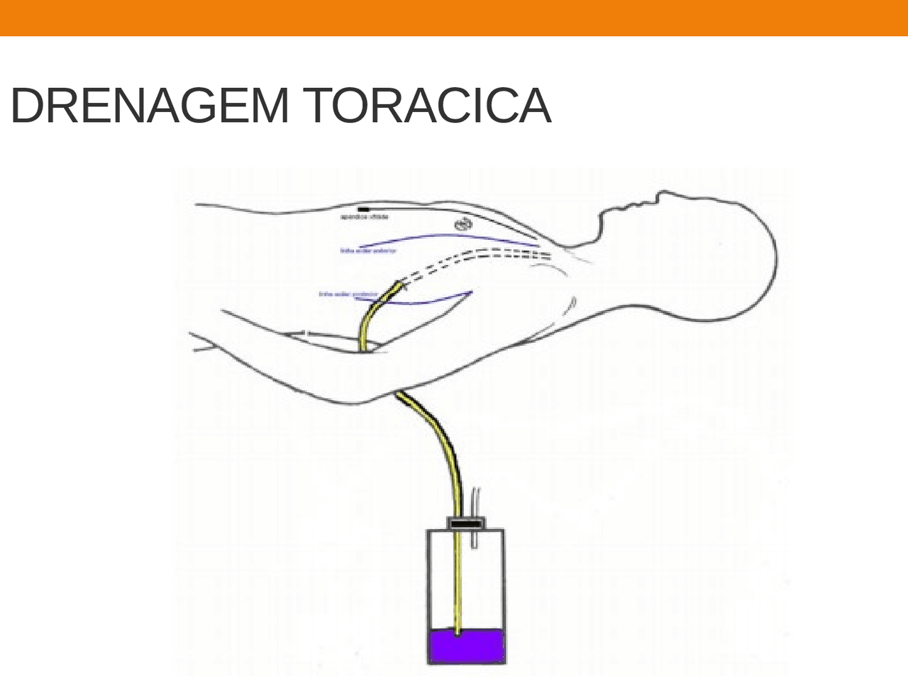 DRENO TORAX BOLADÃO MC GEGE - Docsity