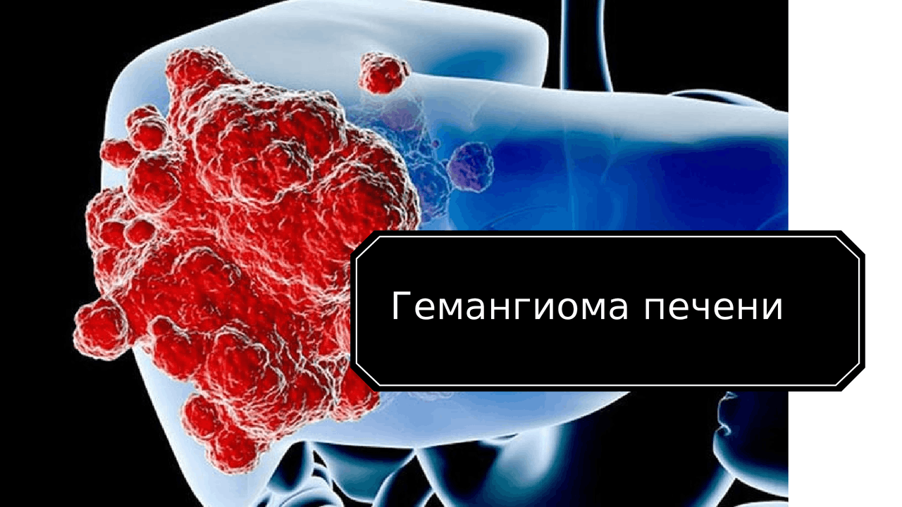 Гемангиома печени презентация Docsity