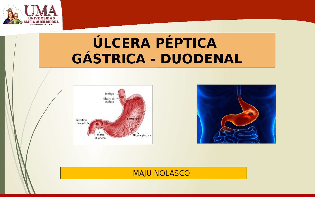 Anatomía De La úlcera Péptica