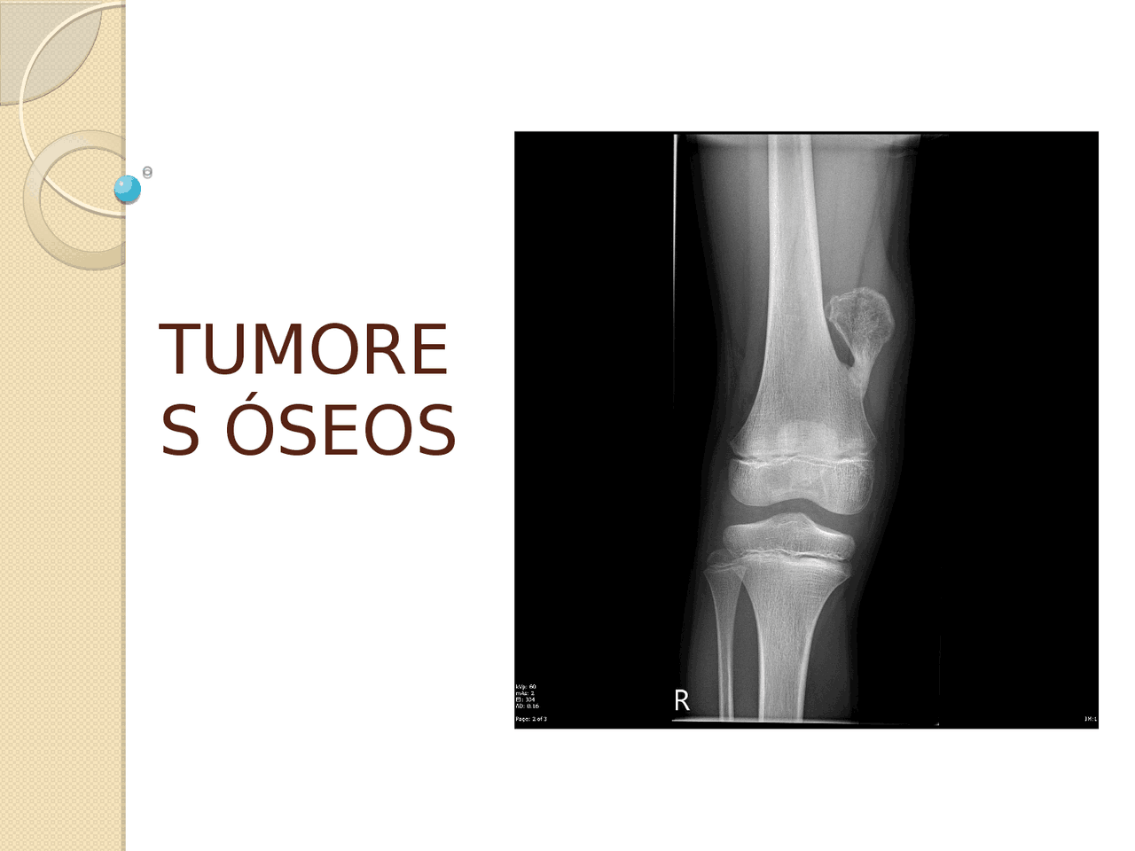 Generalidades y aspectos médicos de tumores óseos - Docsity