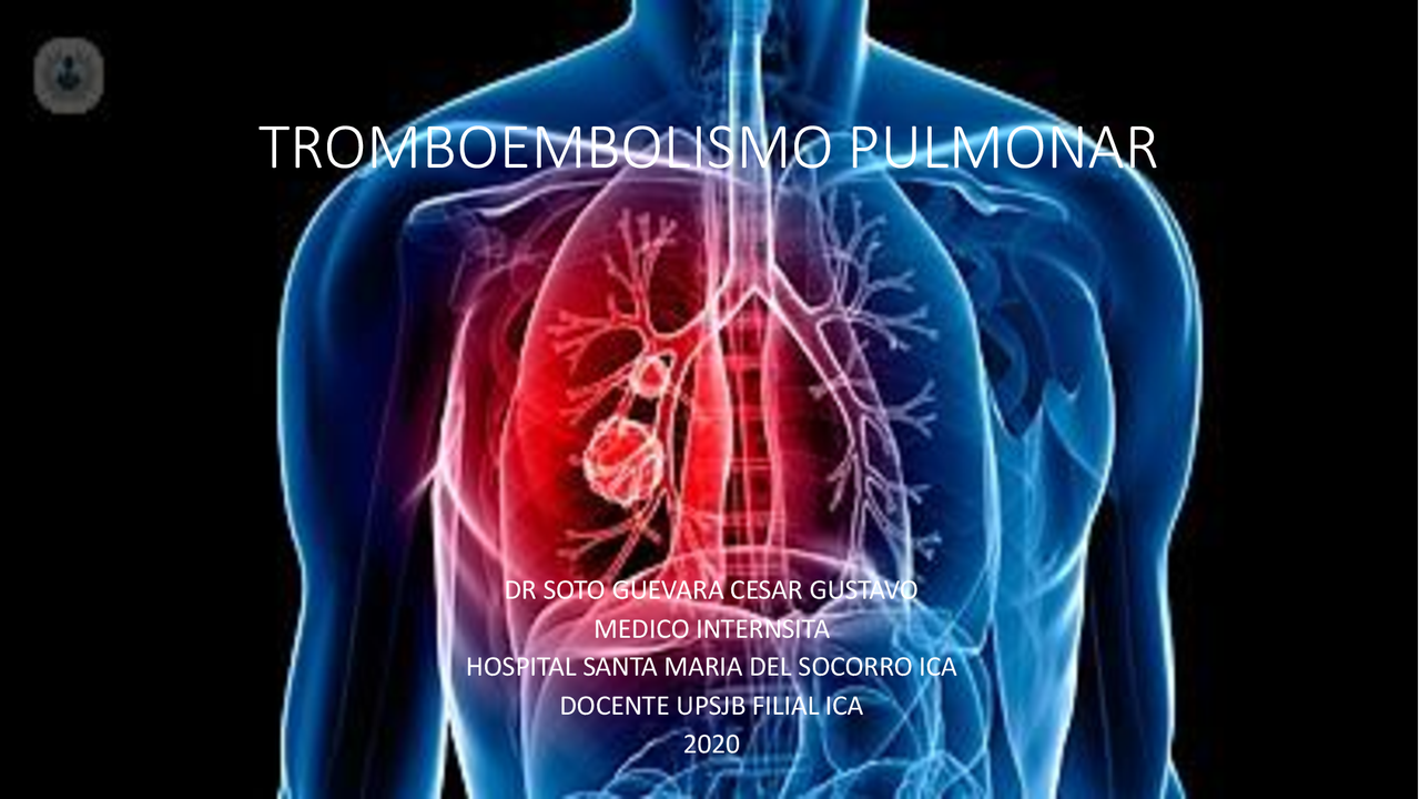 TROMBOEMBOLISMO PULMONAR - Docsity