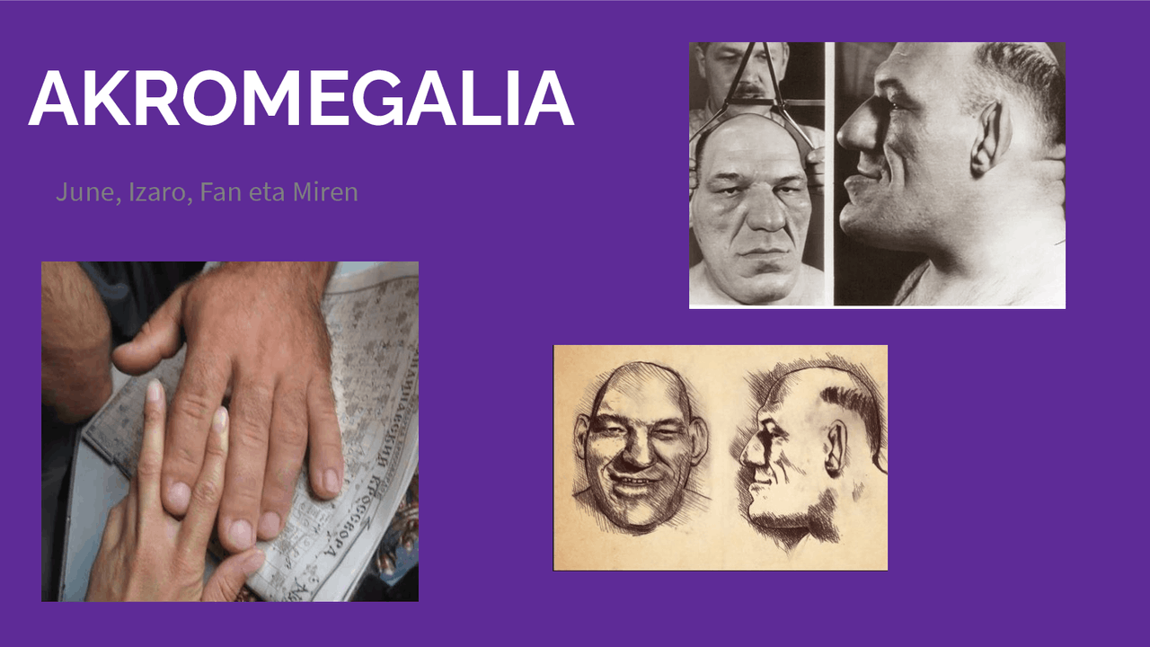 Anatomía: akromegalia gaixotasunari buruzko informazioa - Docsity