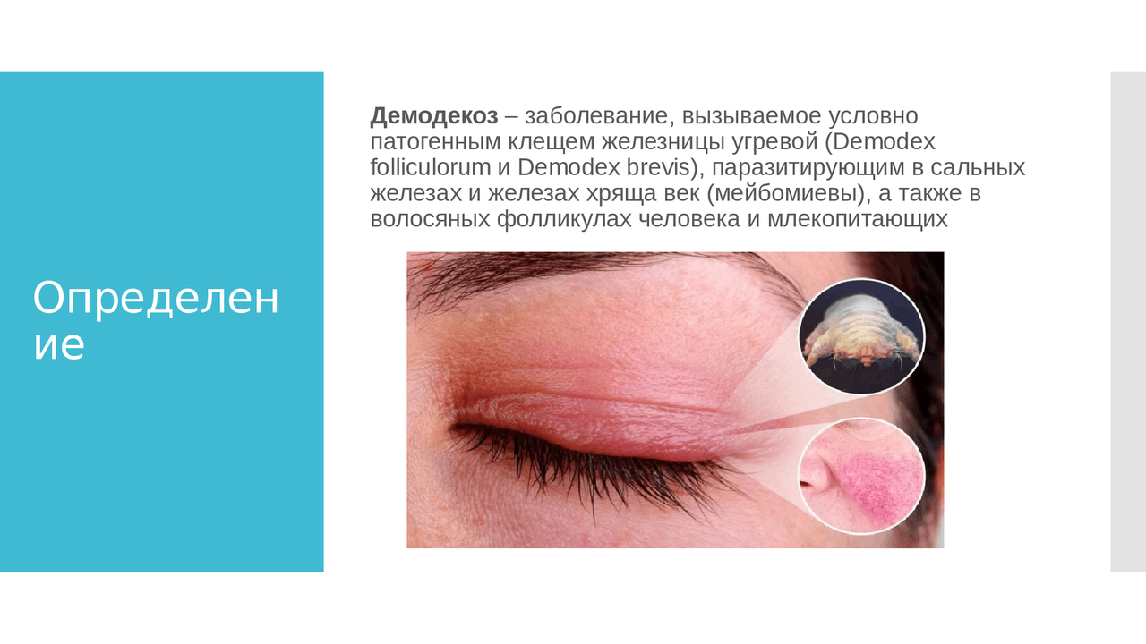 Демодекоз глаз Презентация по офтальмологии Docsity