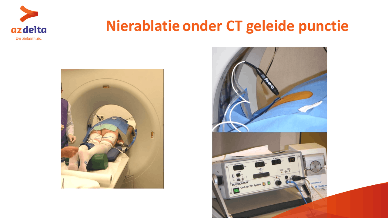 Nierablatie onder CT geleide punctie | Anatomie en fysiologie van de ...