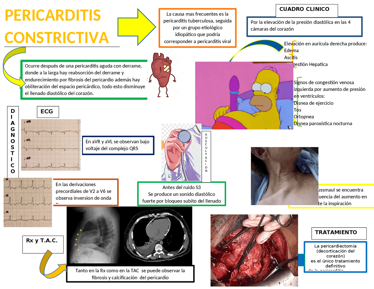 Pericarditis Constrictiva | Esquemas y mapas conceptuales de Cardiología | Docsity