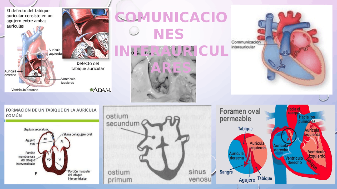 Malformaciones comunicaciones interauriculares - Docsity