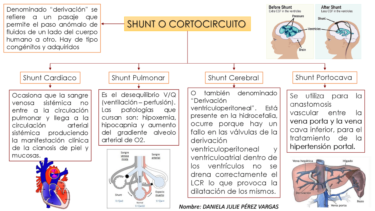 Shunt o Cortocircuito | Esquemas y mapas conceptuales de Fisiopatología ...
