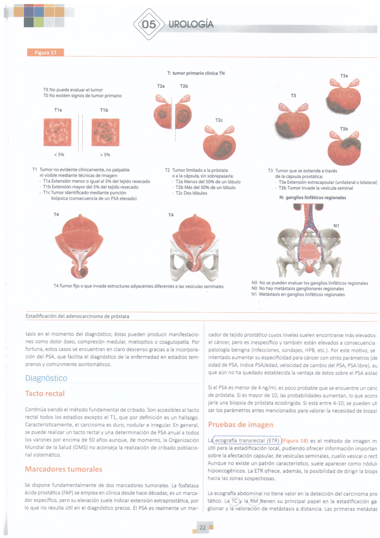 UROLOGIA - Tumor Vesical TNM - Docsity